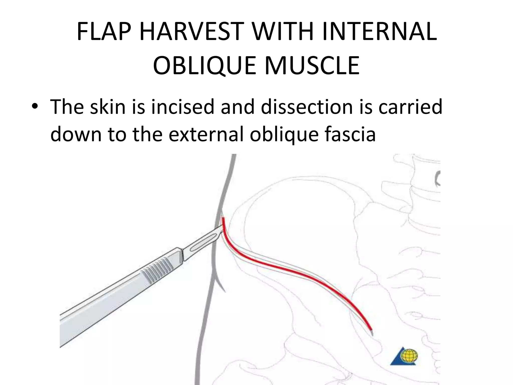 Deep circumflex iliac artery flap | PPTX