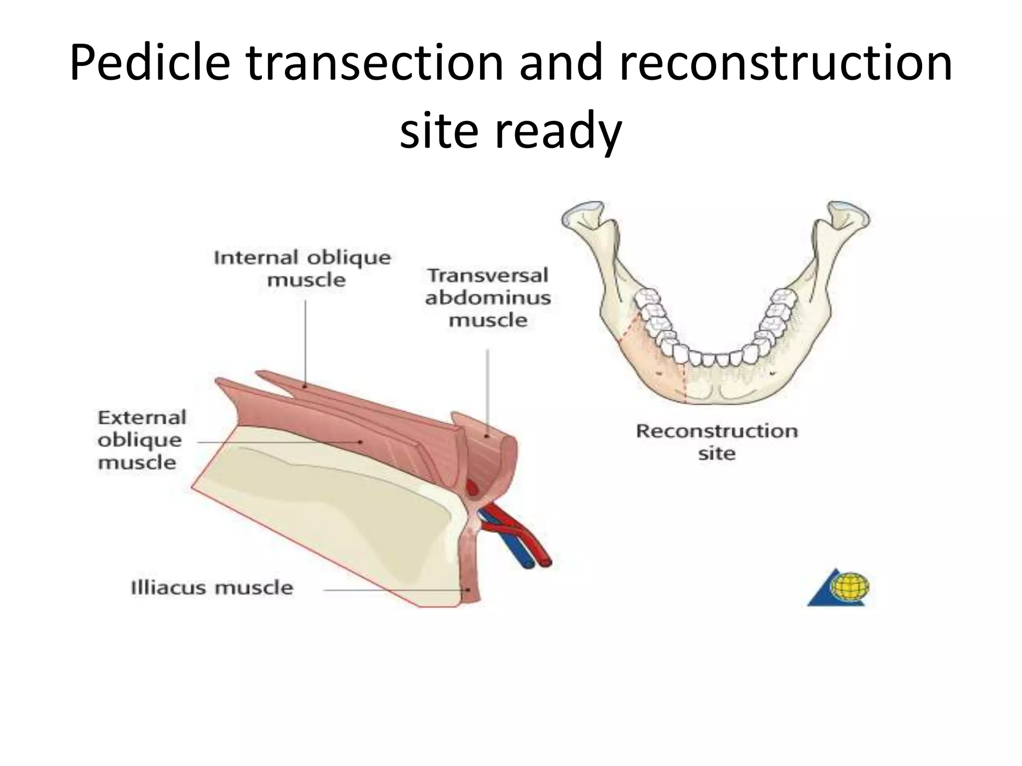 Deep circumflex iliac artery flap | PPTX