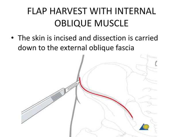 Deep circumflex iliac artery flap | PPTX