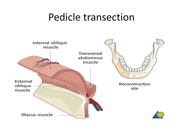 Deep circumflex iliac artery flap | PPTX
