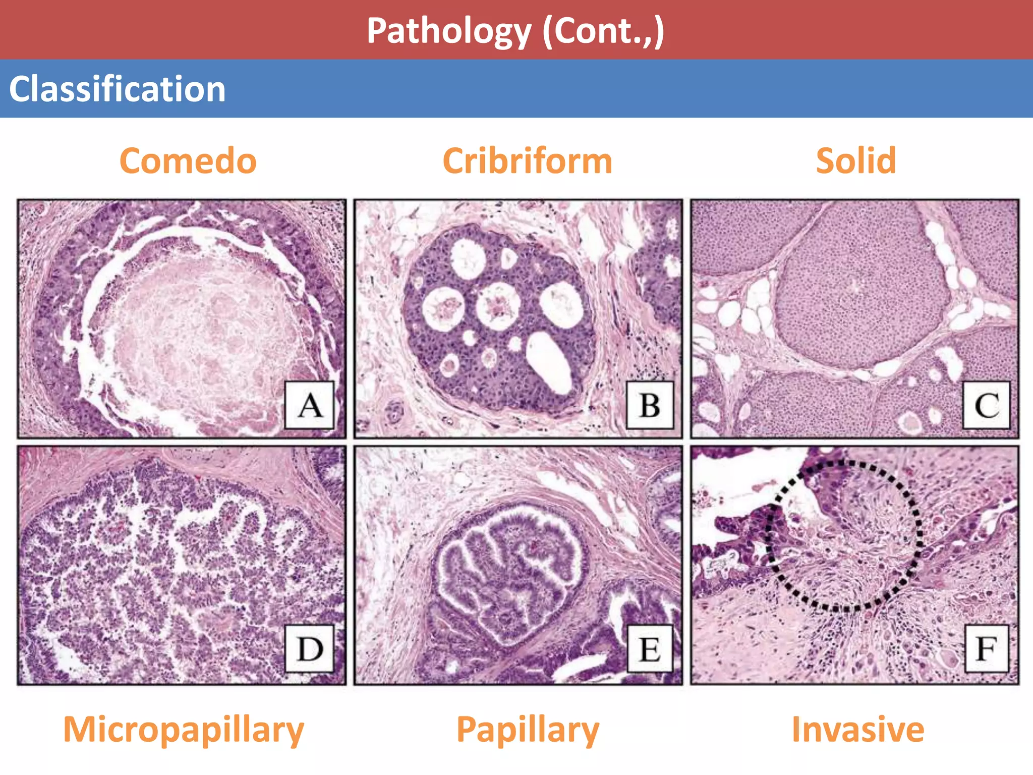 Ductal Carcinoma In Situ Dcis Ppt