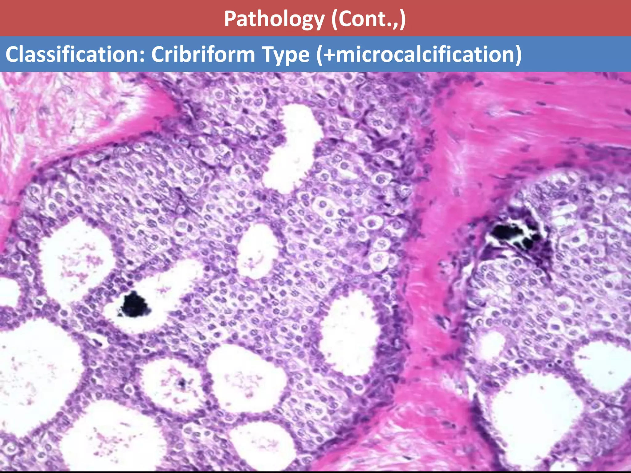 Ductal Carcinoma In Situ (DCIS) | PPTX