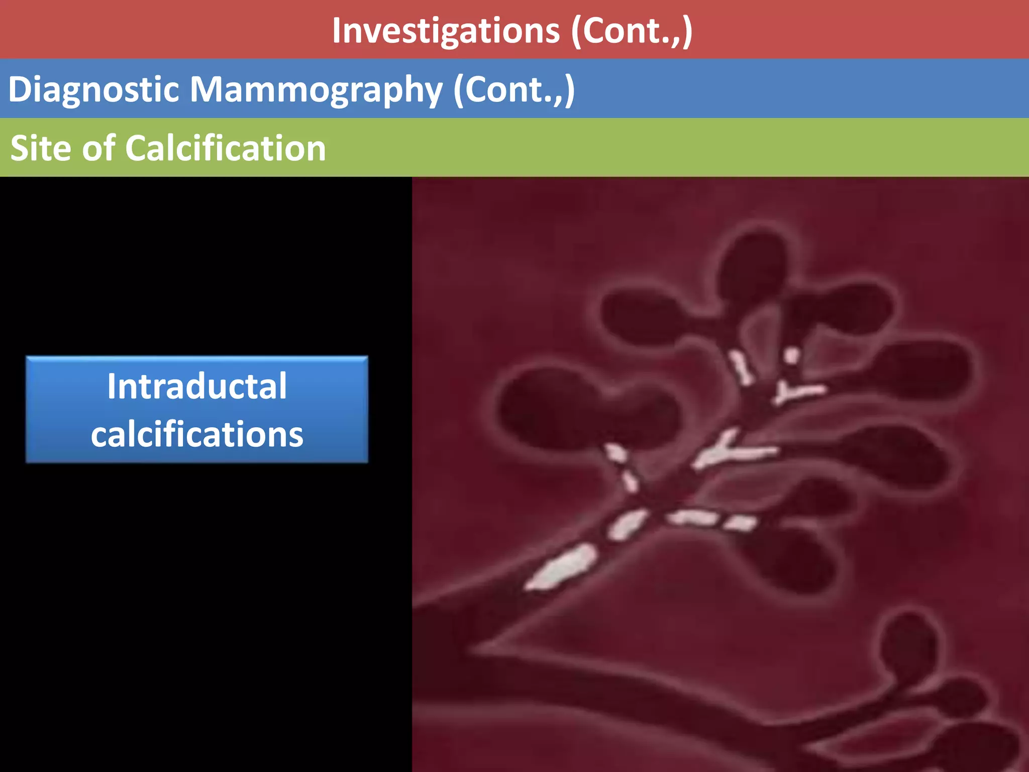 Ductal Carcinoma In Situ (DCIS) | PPTX