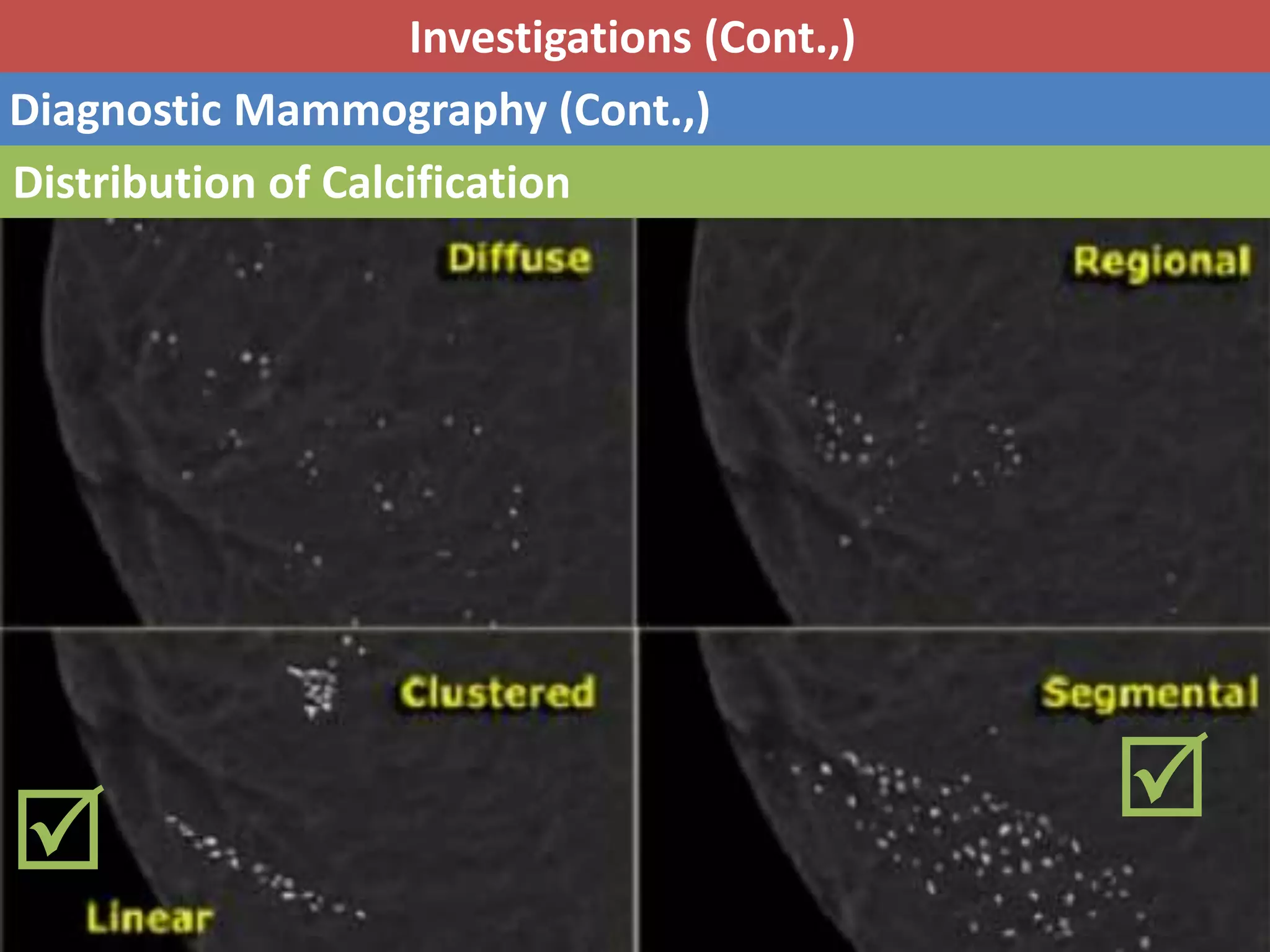 Ductal Carcinoma In Situ (DCIS) | PPTX
