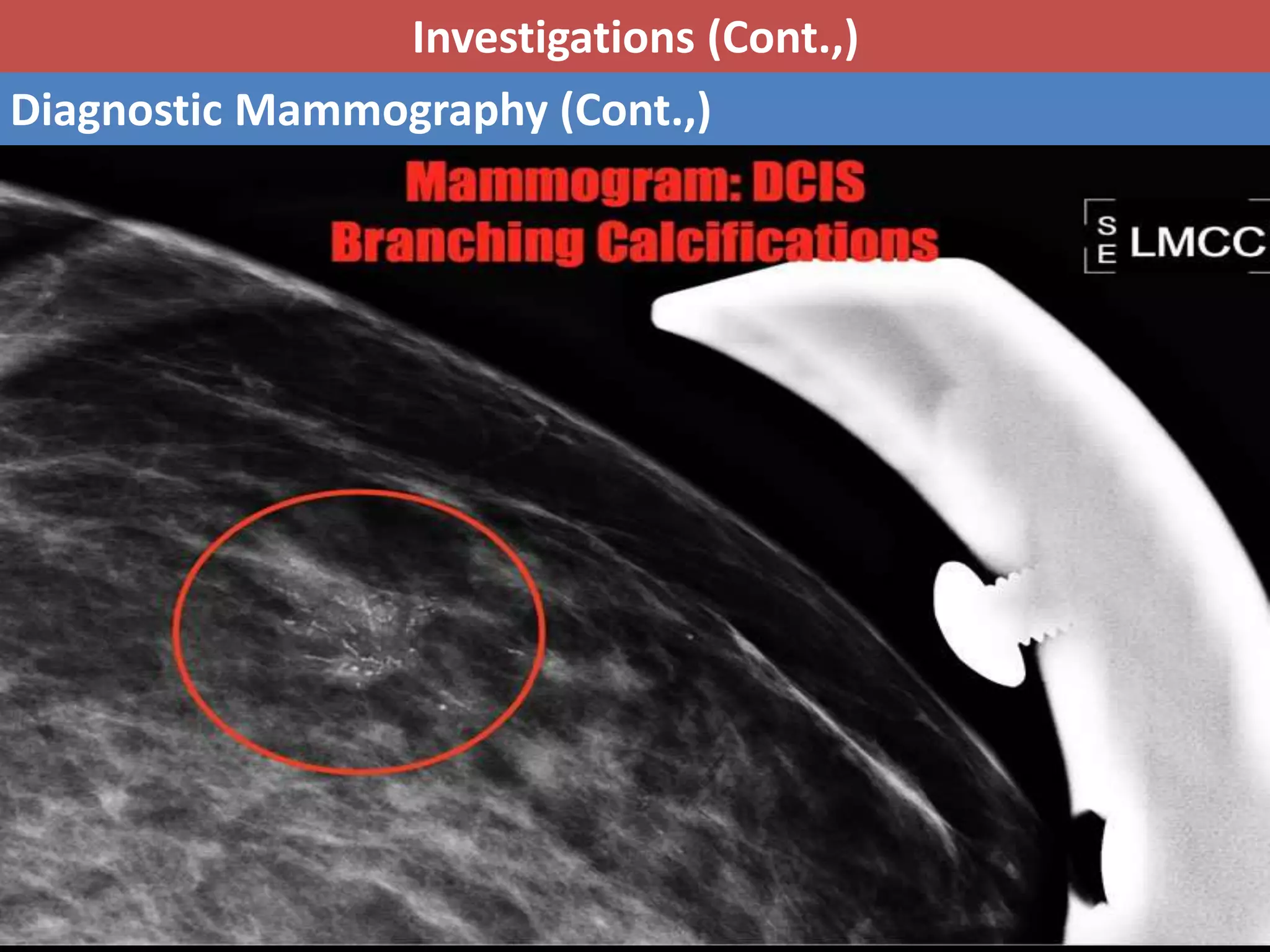 Ductal Carcinoma In Situ Dcis Ppt