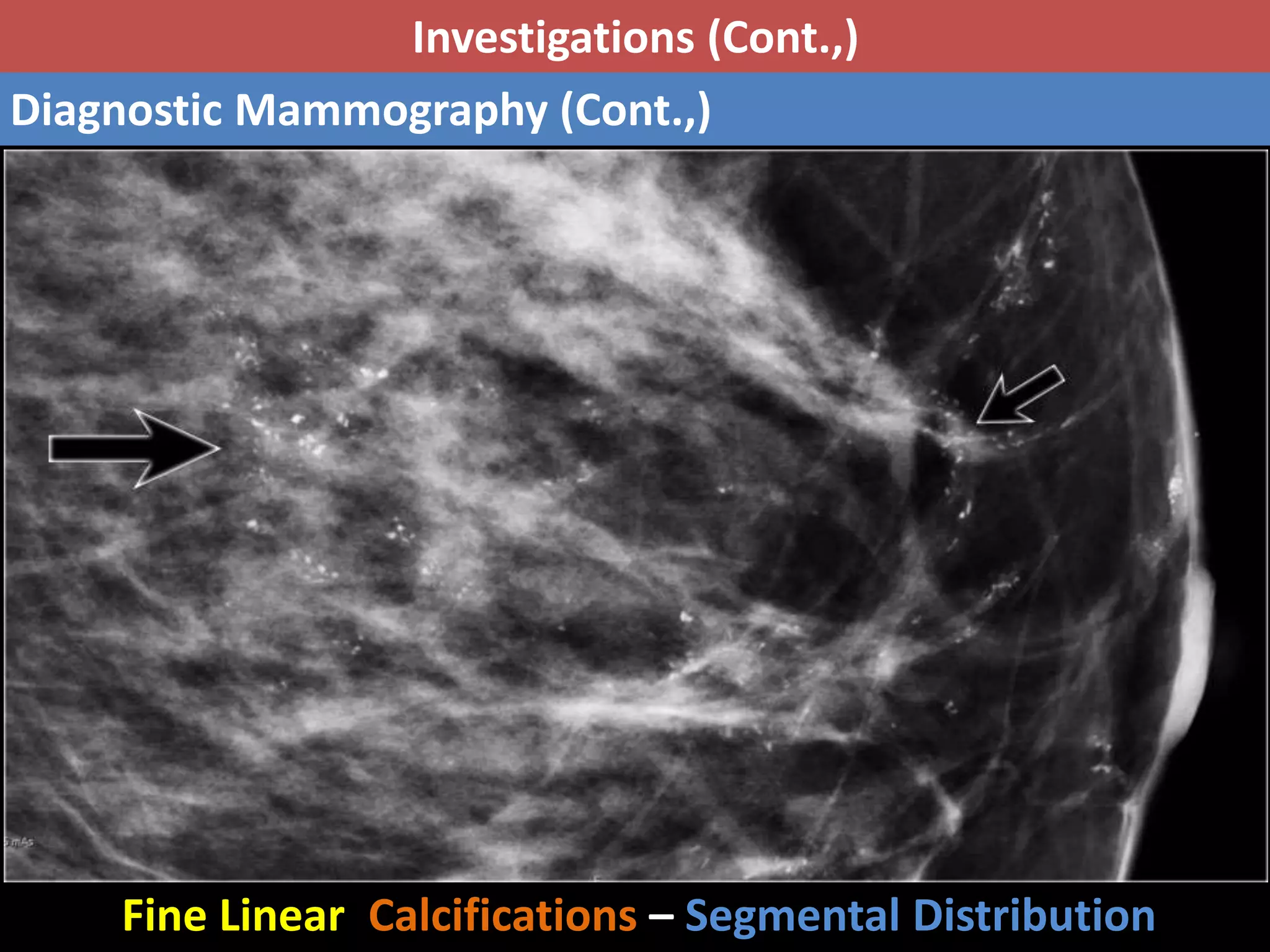 Ductal Carcinoma In Situ (DCIS) | PPTX