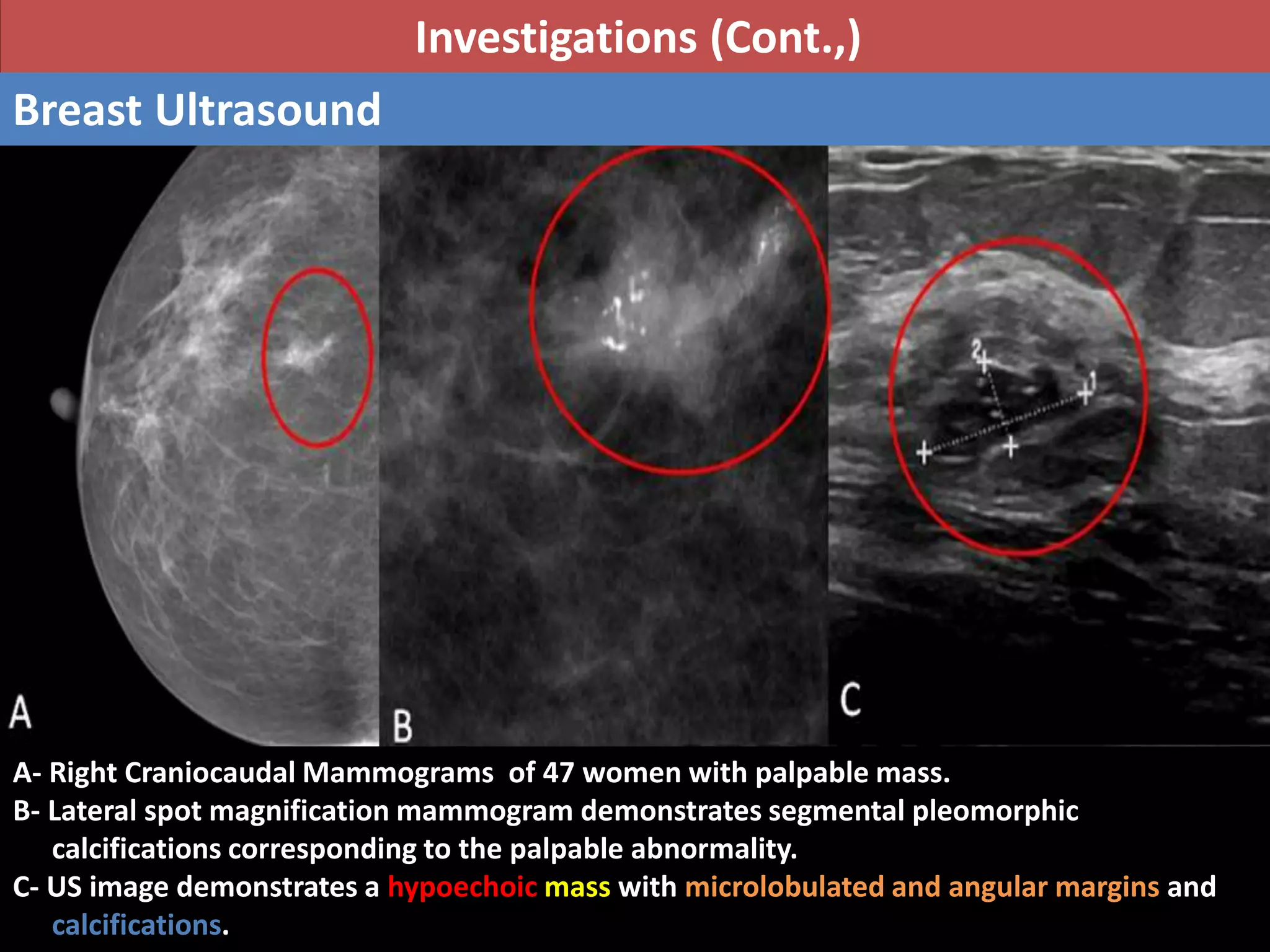 Ductal Carcinoma In Situ (DCIS) | PPTX