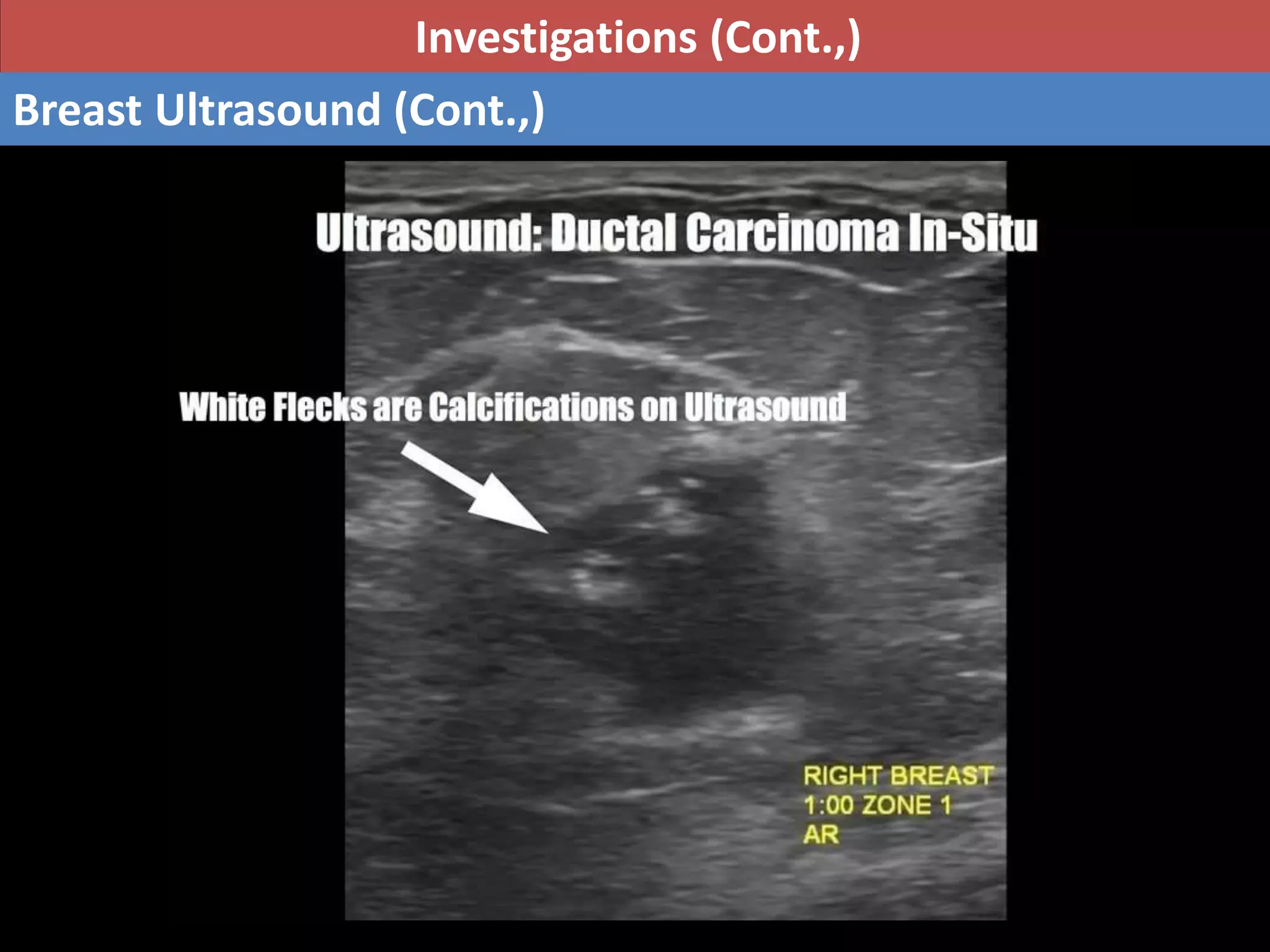 Ductal Carcinoma In Situ (DCIS) | PPTX
