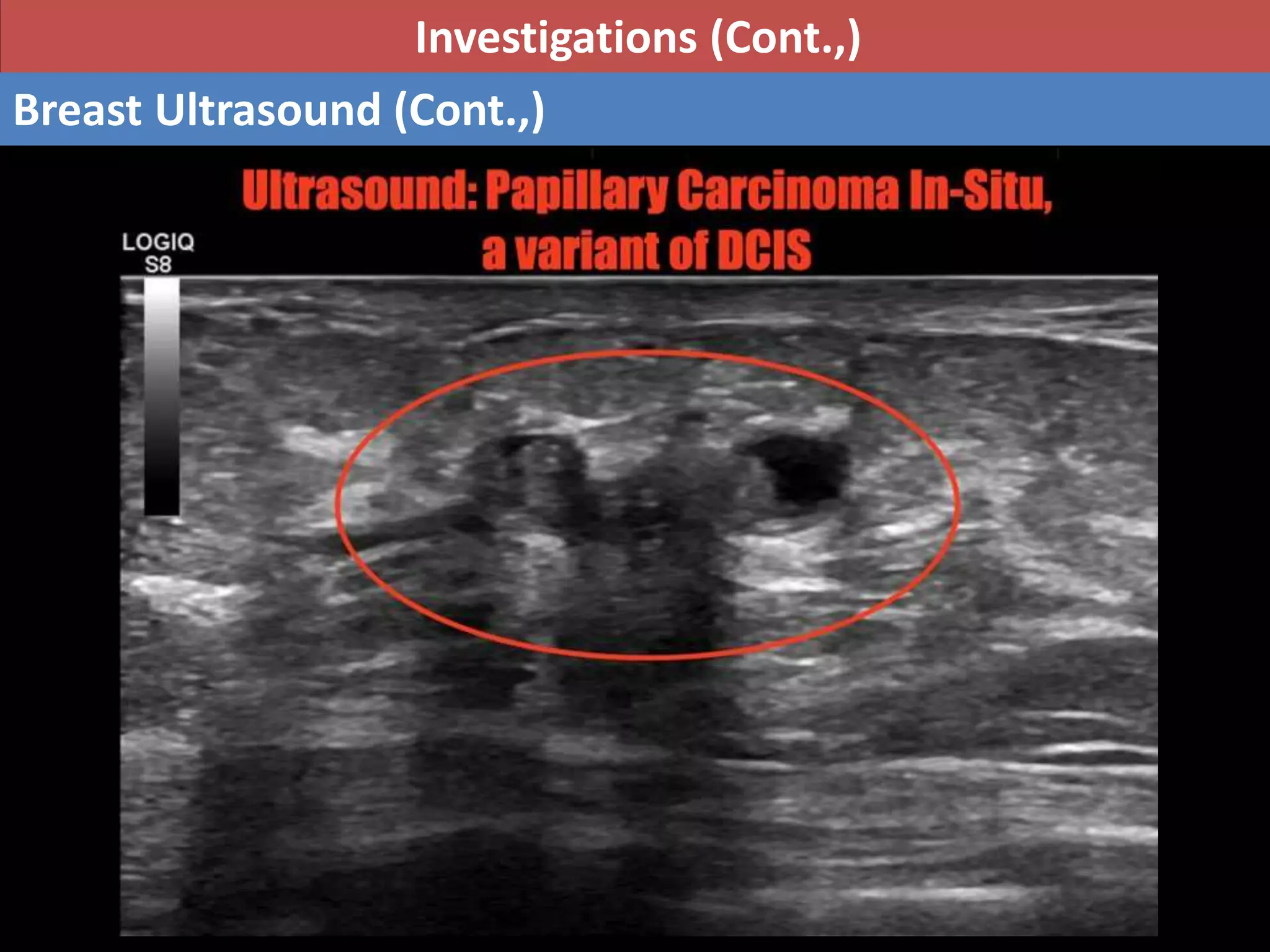 Ductal Carcinoma In Situ (DCIS) | PPTX | Cancer | Diseases and Conditions