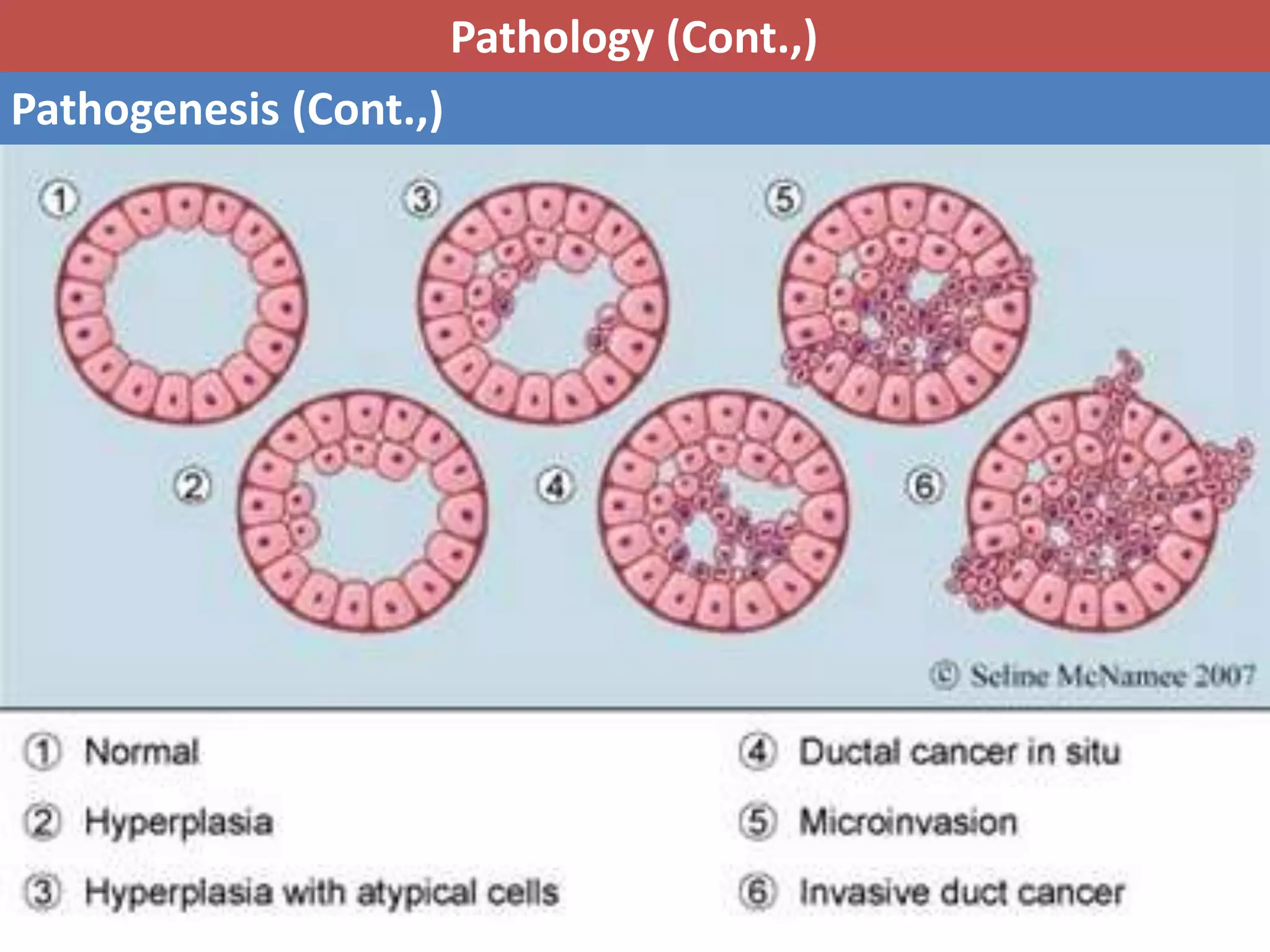 Ductal Carcinoma In Situ Dcis Ppt