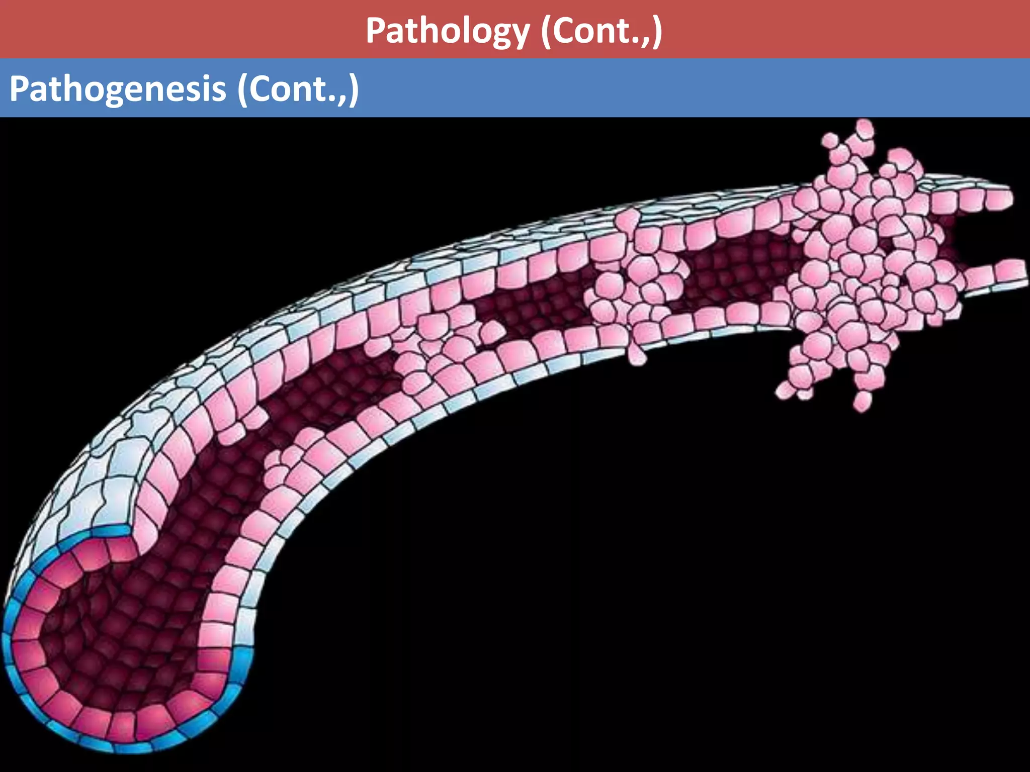 Ductal Carcinoma In Situ (DCIS) | PPTX