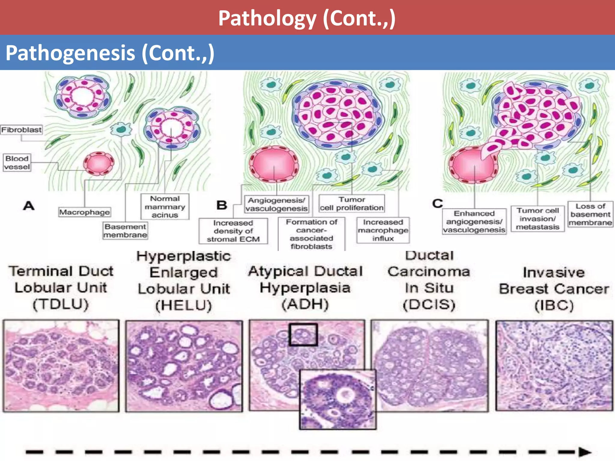 Ductal Carcinoma In Situ (DCIS) | PPTX | Cancer | Diseases and Conditions