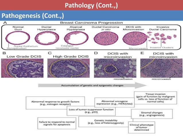 Ductal Carcinoma In Situ (DCIS) | PPTX | Cancer | Diseases and Conditions