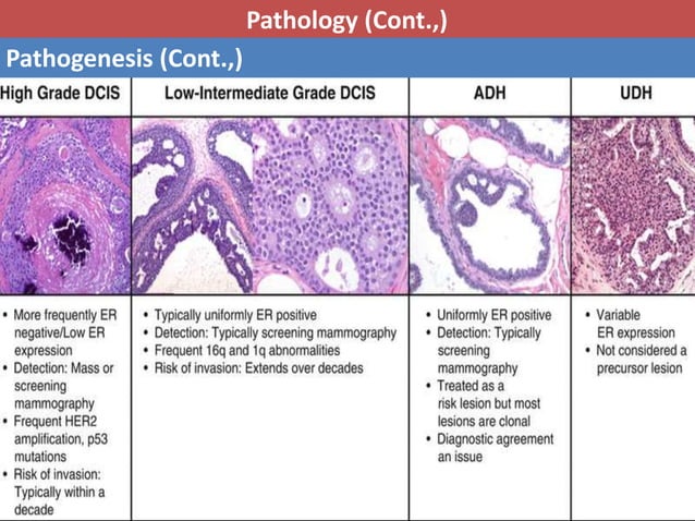 Ductal Carcinoma In Situ (DCIS) | PPTX | Cancer | Diseases and Conditions