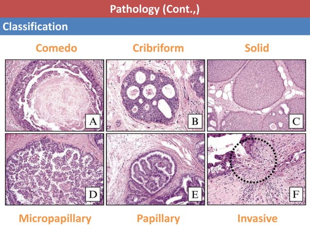 Ductal Carcinoma In Situ (DCIS) | PPTX | Cancer | Diseases and Conditions