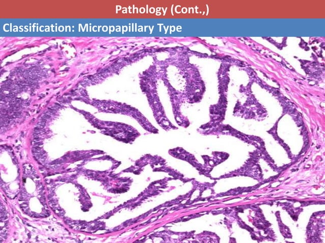 Ductal Carcinoma In Situ (DCIS) | PPTX | Cancer | Diseases and Conditions