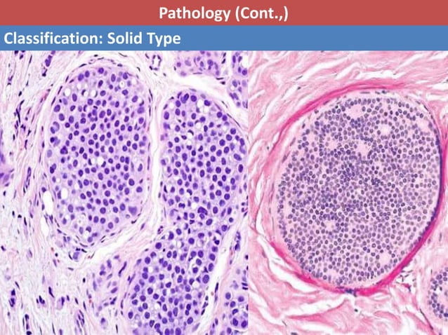 Ductal Carcinoma In Situ (DCIS) | PPTX | Cancer | Diseases and Conditions