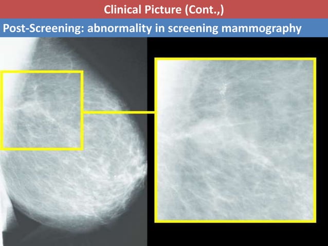 Ductal Carcinoma In Situ (DCIS) | PPTX | Cancer | Diseases and Conditions