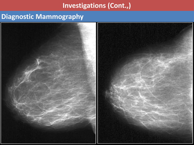 Ductal Carcinoma In Situ (DCIS) | PPTX | Cancer | Diseases and Conditions