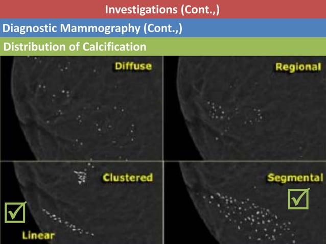 Ductal Carcinoma In Situ (DCIS) | PPTX | Cancer | Diseases and Conditions