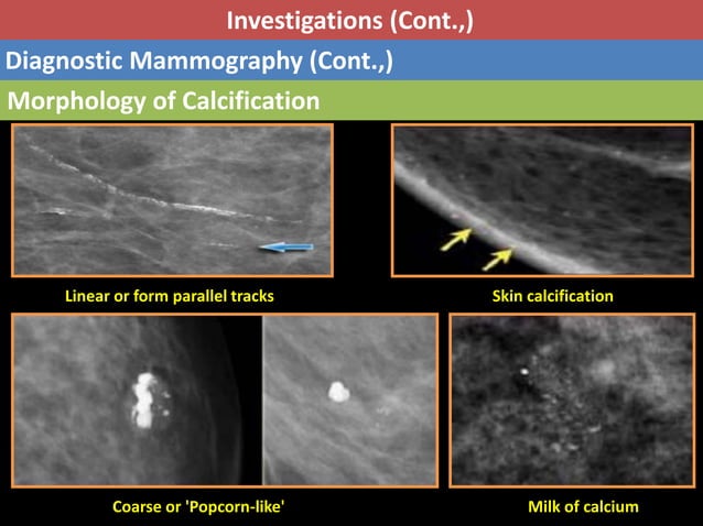 Ductal Carcinoma In Situ (DCIS) | PPTX | Cancer | Diseases and Conditions