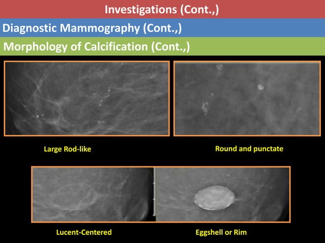 Ductal Carcinoma In Situ (DCIS) | PPTX | Cancer | Diseases and Conditions
