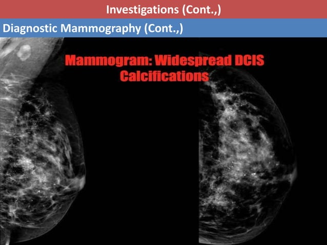 Ductal Carcinoma In Situ (DCIS) | PPTX | Cancer | Diseases and Conditions