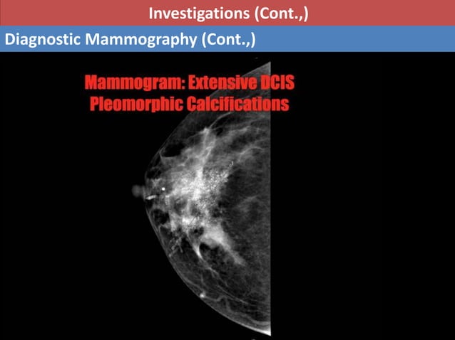 Ductal Carcinoma In Situ (DCIS) | PPTX | Cancer | Diseases and Conditions