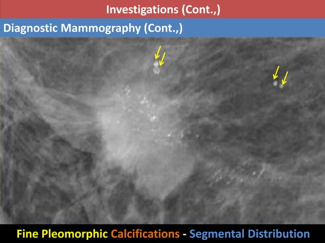 Ductal Carcinoma In Situ (DCIS) | PPTX | Cancer | Diseases and Conditions