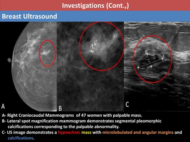 Ductal Carcinoma In Situ (DCIS) | PPTX | Cancer | Diseases and Conditions