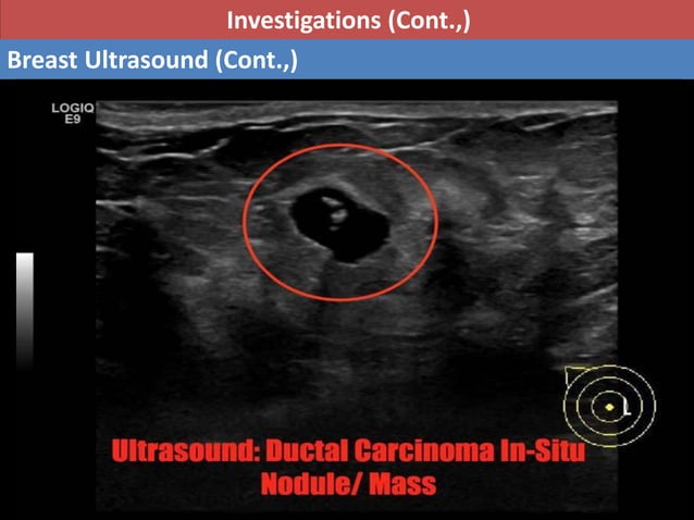 Ductal Carcinoma In Situ (DCIS) | PPTX | Cancer | Diseases and Conditions