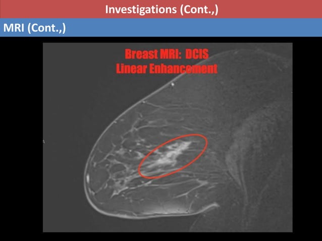 Ductal Carcinoma In Situ (DCIS) | PPTX | Cancer | Diseases and Conditions