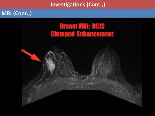 Ductal Carcinoma In Situ (DCIS) | PPTX | Cancer | Diseases and Conditions