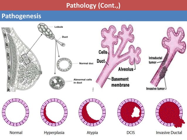 Ductal Carcinoma In Situ (DCIS) | PPTX | Cancer | Diseases and Conditions