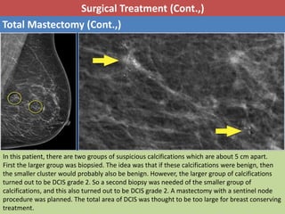 Ductal Carcinoma In Situ (DCIS) | PPTX