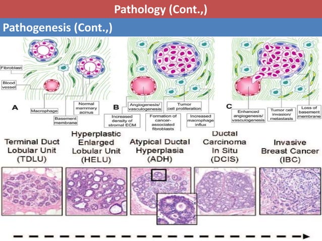 Ductal Carcinoma In Situ (DCIS) | PPTX | Cancer | Diseases and Conditions