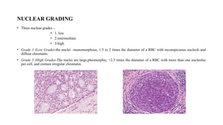 Ductal carcinoma in situ breast- management and pathology | PPTX