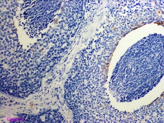 Dcis Breast Invasive | PPT