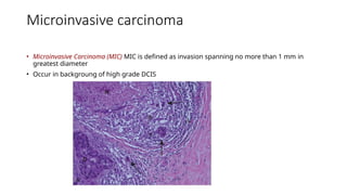 Ductal carcinoma in situ of breast - classification and management | PPT