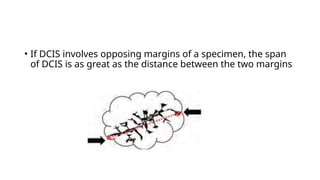 Ductal carcinoma in situ of breast - classification and management | PPT
