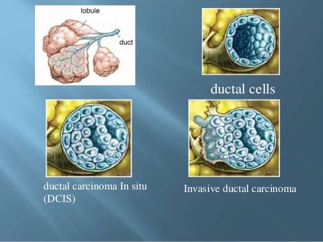 Ductal carcinoma in situ
