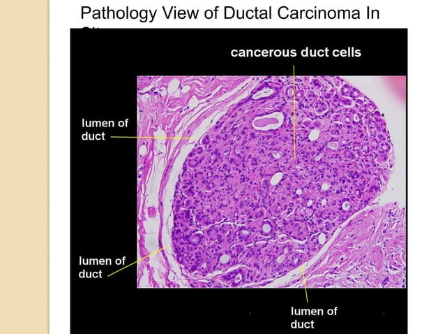DCIS Breast Cancer | PPTX