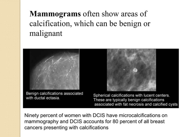 DCIS Breast Cancer | PPTX