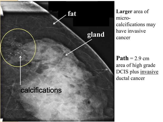 DCIS Breast Cancer | PPTX