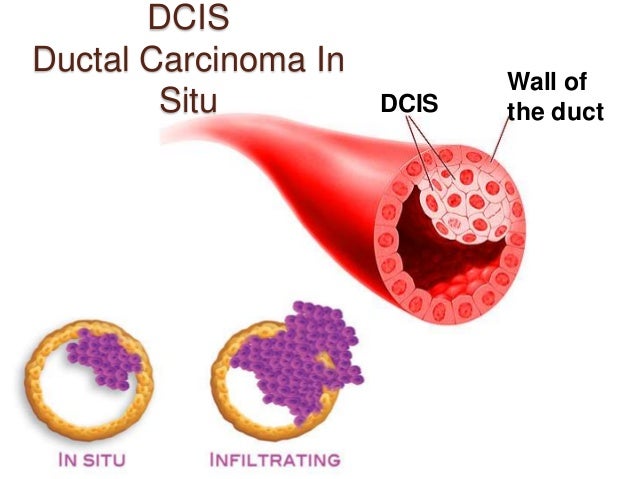 DCIS Breast Cancer