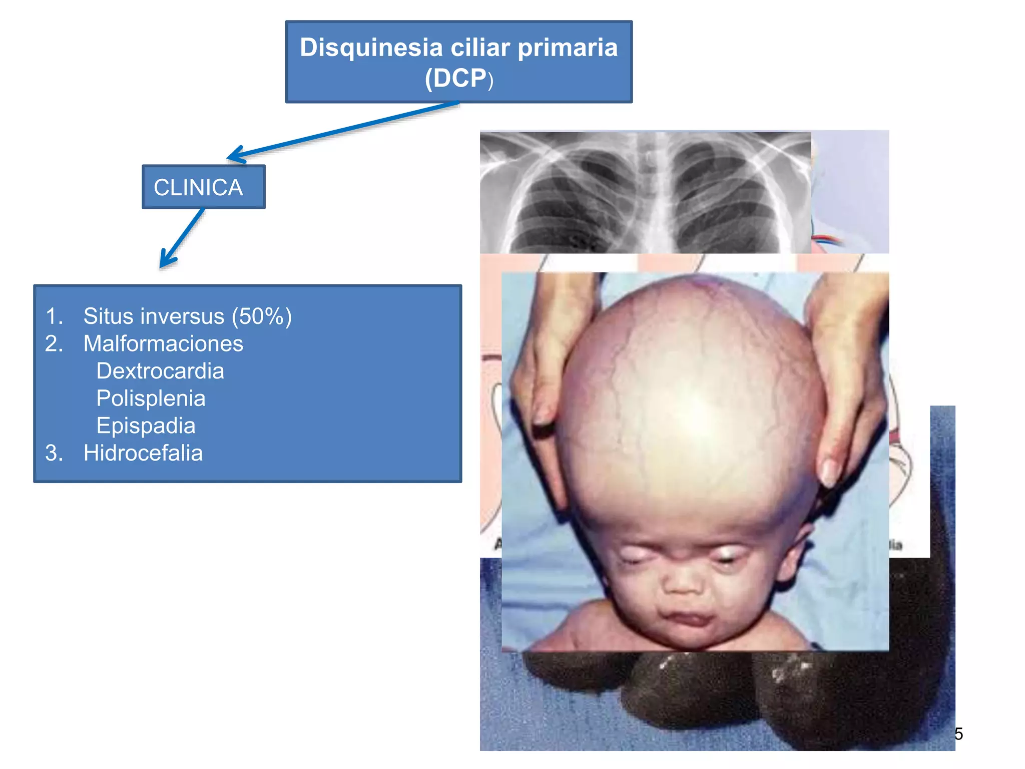 Discinesia ciliar primaria DCP | PPTX | Ear, Nose and Throat Conditions ...