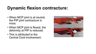 dupuytrens contracture | PPTX | Death, Injury, or Military Conflict ...