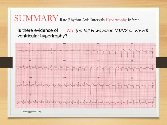 Electro Cardio Gram - Basics of ECG