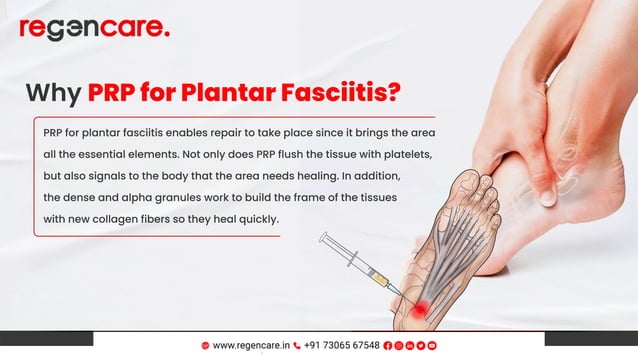 Why to Choose PRP for Plantar Fasciitis? | PDF