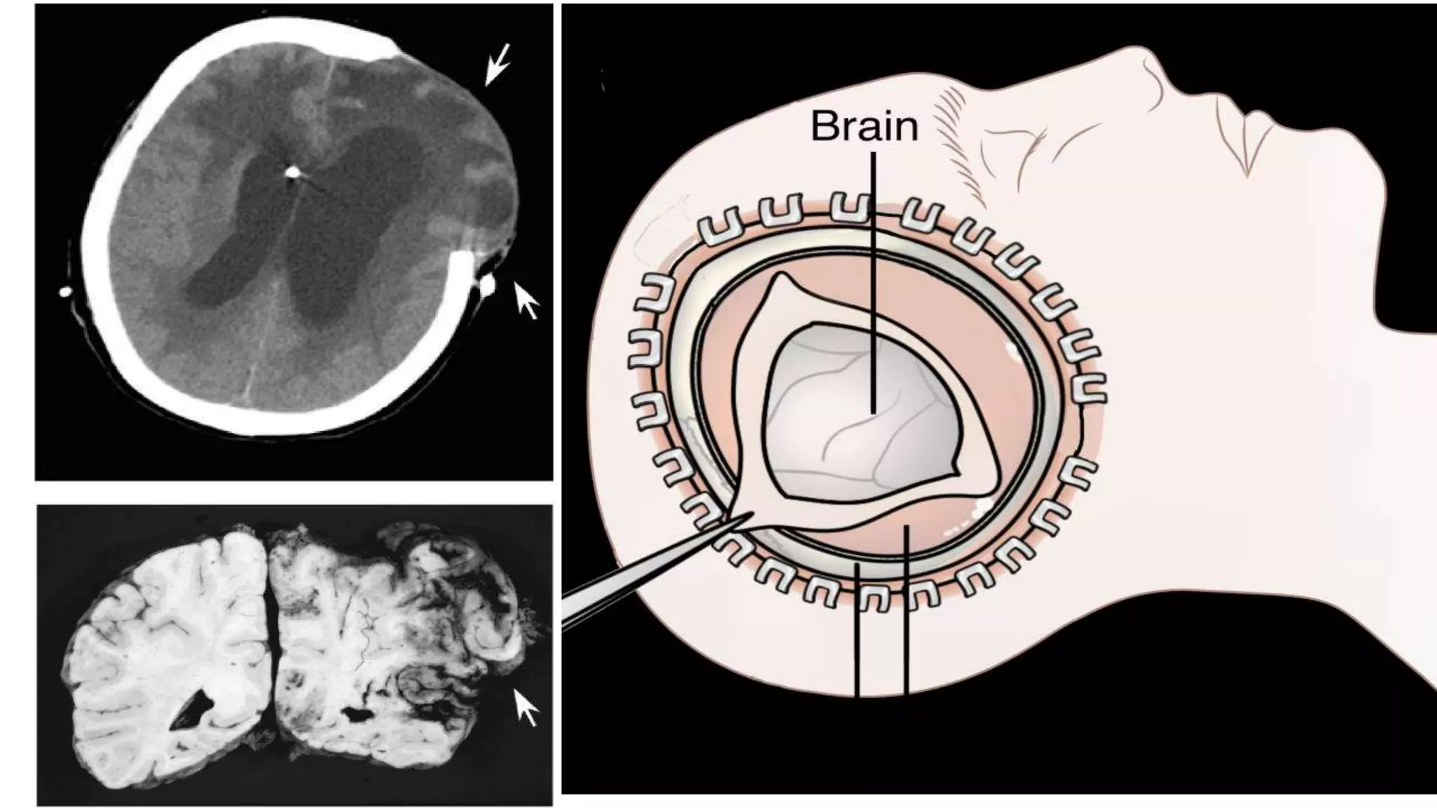 Decompressive craniectomy | PPTX